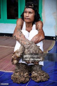 The Incredible Story of Dede Koswara: The 'Tree Man' of Indonesia - Relak LA